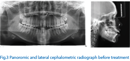 X Ray Open Bite