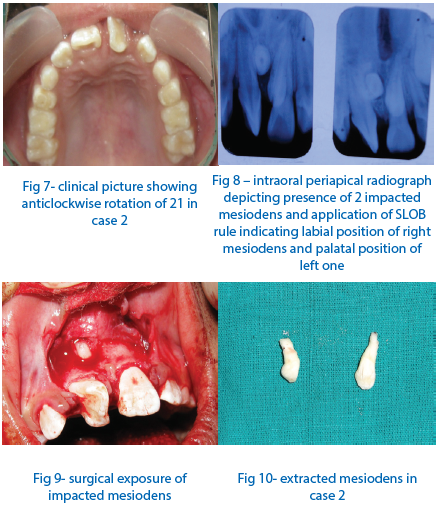 Supernumerary Teeth Mesiodens