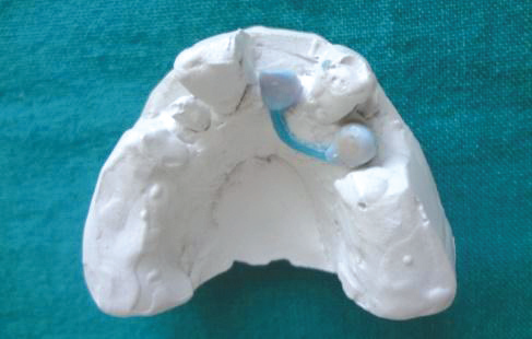 Spring Cantilever Bridge Dental