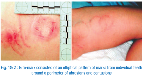 Human Bite Marks On Skin