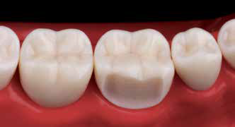 Class I Cavity Preparation For Composite Mandibular Molar, 51% OFF