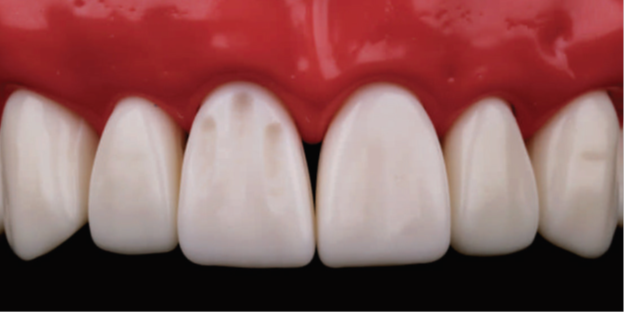 Labial Reduction