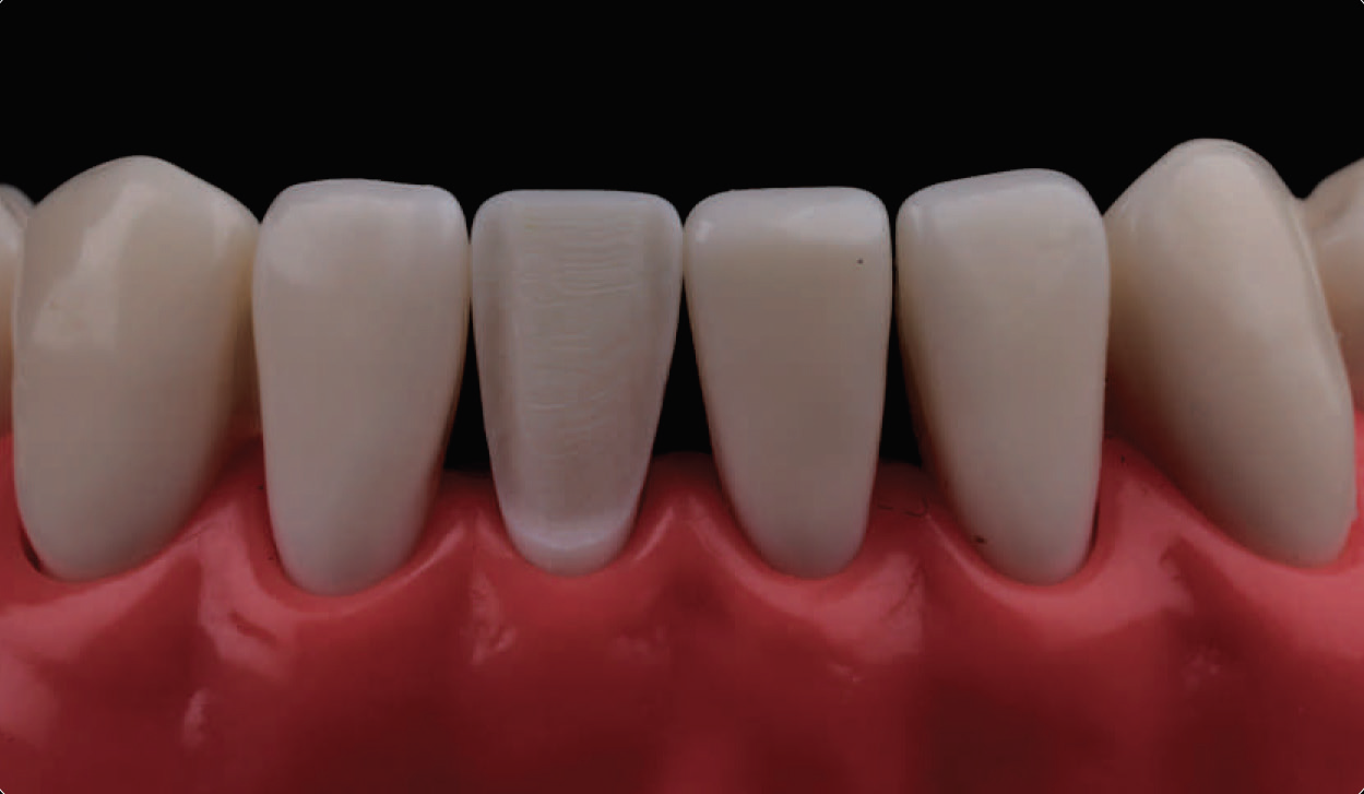 Labial Reduction