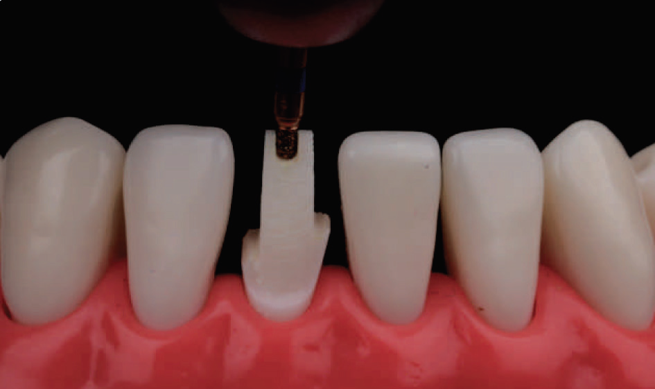 Mandibular Central Incisor Crown Preparation