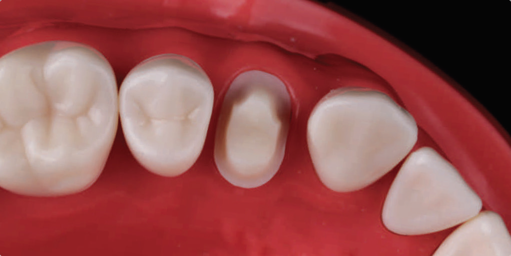 Porcelain Fused To Metal Crown Preparation